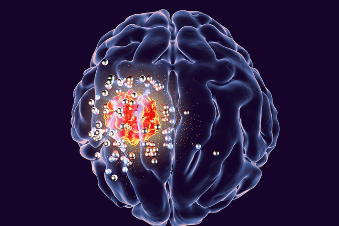 New AI tool can decode brain cancer’s genome during surgery